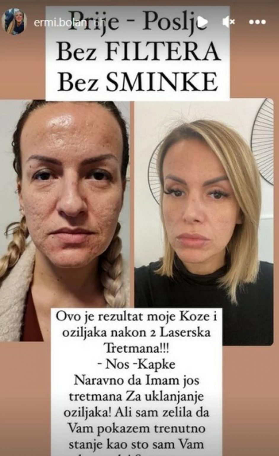 Nos 3.000€, mačje oči 4.000€, gr.udi 3.800€.. Ali to je samo početak ...